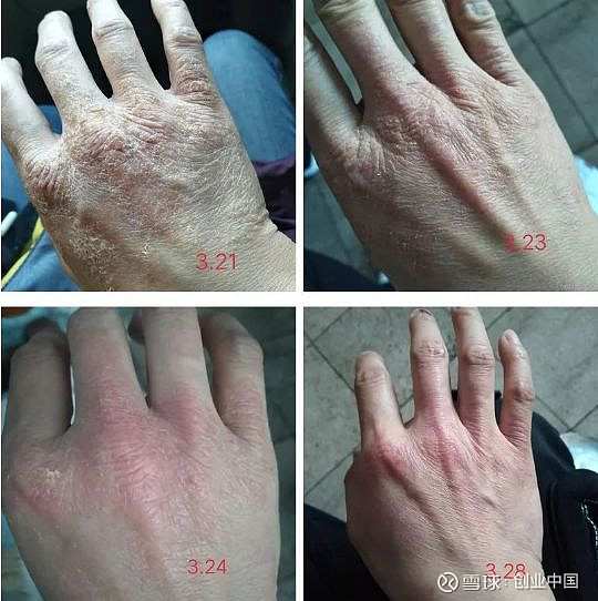 手脚脱皮、干裂？藏药变态换皮术，一抹全解决！ 光滑白皙的手、脚 最能展现一个人的生活状态 秋冬天，很多人脸蛋青春美丽 手脚却爬满裂纹、干皮、老茧天气干冷更会加重干裂、 雪球