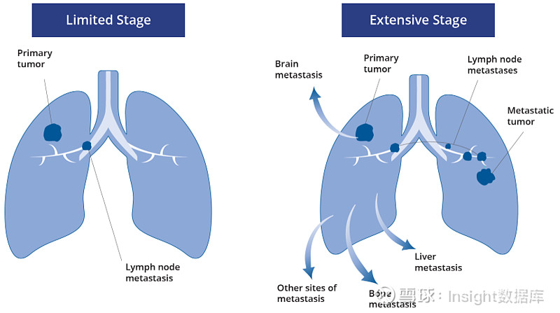 免疫疗法突破生存瓶颈后，小细胞肺癌（SCLC）即将迎来更多新疗法 肺癌是全球发病率和致死率都是最高的癌症之一，与占肺癌人群 85% 的晚期非小细胞肺癌（NSCLC）在过去的 10 多年里 ...