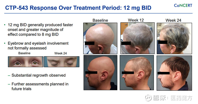 有效治疗脱发！氘代芦可替尼获FDA突破性疗法资格 7月8日， Concert 制药公司宣布FDA授予口服JAK抑制剂CTP-543治疗成人中 ...