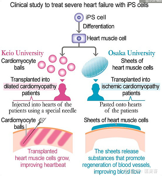 iPS细胞再下一城！日本卫生部批准治疗扩张型心肌病的临床研究丨医麦猛爆料 本文由医麦客原创，欢迎分享，转载须授权 2020年9月2日/医麦客 ...