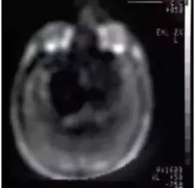 核磁共振成像（MRI）的发展史 核磁共振成像 (NMRI，Nuclear Magnetic Resonance Imaging)，也称磁共振 ...