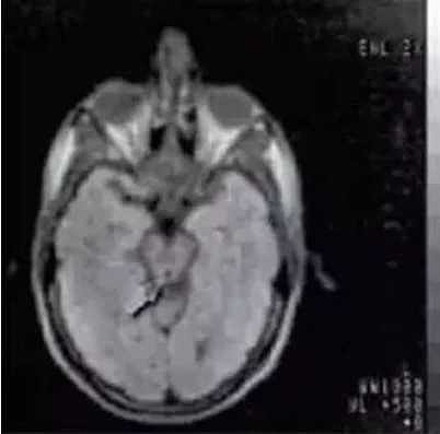 核磁共振成像（MRI）的发展史 核磁共振成像 (NMRI，Nuclear Magnetic Resonance Imaging)，也称磁共振 ...