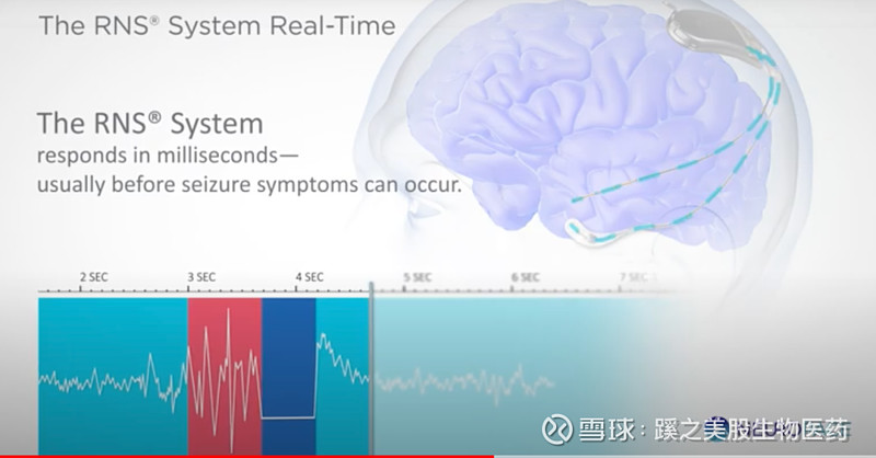 IPO早知道 | NeuroPace: 实时记录、治疗癫痫的植入型神经设备公司申请7500... 作者：Wenjing 微信公众号：蹊之美股 ...