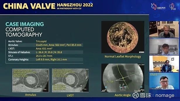 沛瓣AR，聚焦ALIGN | 沛嘉反流瓣JenaValve Trilogy 杭州瓣膜会首次公开30天随访数据（转） CHINA VALVE ...