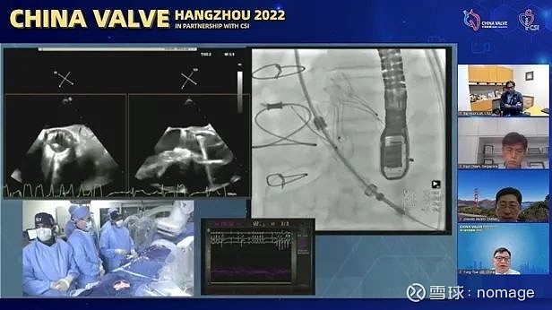 沛瓣AR，聚焦ALIGN | 沛嘉反流瓣JenaValve Trilogy 杭州瓣膜会首次公开30天随访数据（转） CHINA VALVE ...