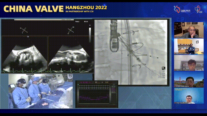沛瓣AR，聚焦ALIGN | 沛嘉反流瓣JenaValve Trilogy 杭州瓣膜会首次公开30天随访数据（转） CHINA VALVE ...