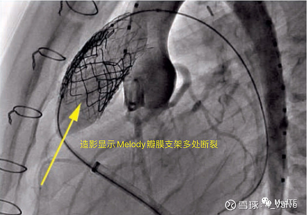 TPVR：国产瓣膜出海的希望？ 近期，TPVR (经导管肺动脉瓣置换)领域好不热闹。先是首款国产肺动脉瓣VenusP-Valve获批CE登陆 ...