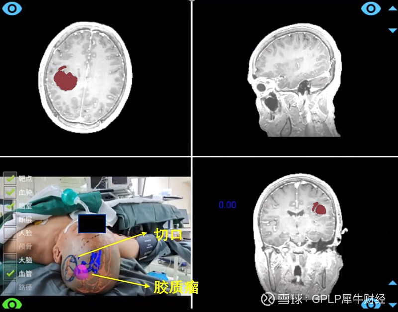 给手术配上GPS 北京协和医院与腾讯联合发布国产手术导航系统 7月5日，北京协和医院联合 腾讯 AI Lab，共同发布了具有完全自主知识产权的 ...