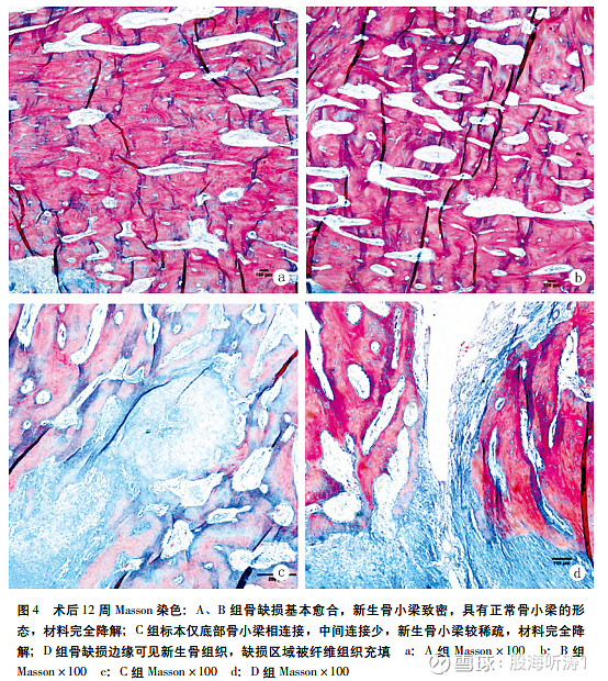 十六年磨一剑，BMP活性生物骨能否颠覆传统骨修复“金标准”？ 摘自《星百医》 01 打破“金标准”骨修复材料一般有自体骨、同种骨、人工合成骨和 ...