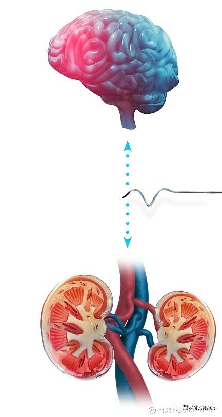 美敦力一波三折的RDN探索之路 文章来源：思宇 MedTech ；编辑： lulu 转载要求：首发24小时后可转载，需注明来源 作为一个年收入 ...