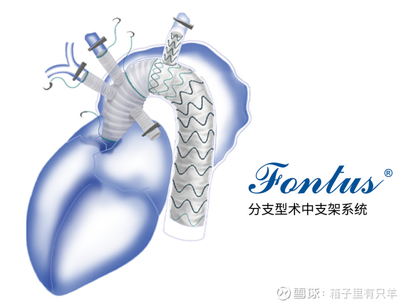 心脉医疗™Fontus®分支型术中支架系统于全国多家医院开展上市后临床应用 心脉医疗™Fontus®分支型术中支架系统于全国多家医院开展上市后临床应用 心脉医疗 Endovastec 2022 ...