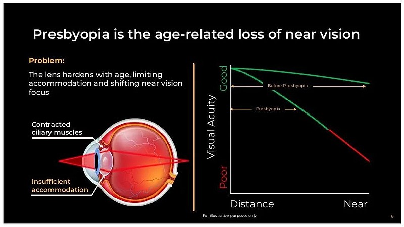 30分钟内见效，维持10小时！老花眼眼药水3期临床试验启动在即 LENZ Therapeutics 今日宣布其两款醋克立定 ...