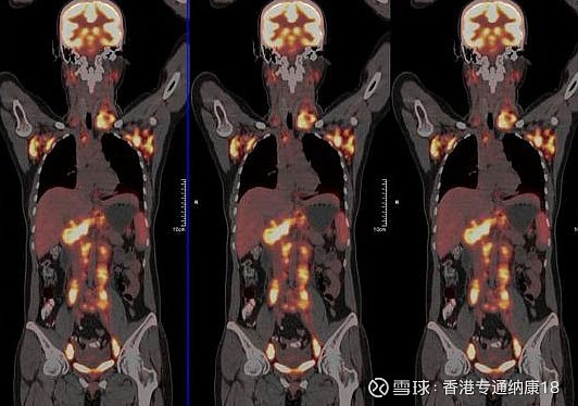 德喜曲妥珠单抗ENHERTU(DS-8201)中国香港已上市中文说明书 DS-8201，通用名：Fam ...