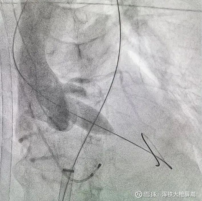 安徽首例 安徽首例ECMO支持下TAVR手术！中国科学技术大学附属第一医院徐健教授团队成功挽救患者生命：多学科协作，共克难关原创 ... - 雪球