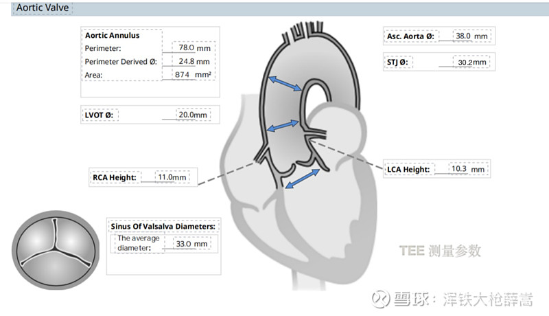 安徽首例 安徽首例ECMO支持下TAVR手术！中国科学技术大学附属第一医院徐健教授团队成功挽救患者生命：多学科协作，共克难关原创 ... - 雪球