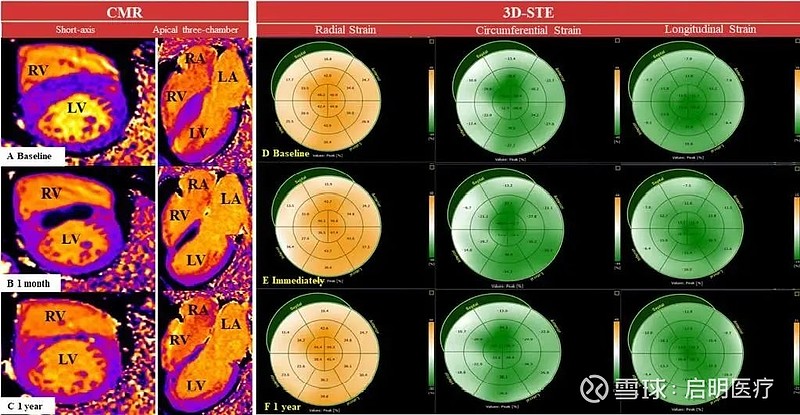 最新研究首次揭示Liwen术式显著改善中远期左室心肌力学 近日，国际心血管权威期刊《Heart》（影响因子7.369）发表最新研究 ...