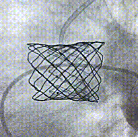 干瓣应用再升级！新一代球扩干瓣Venus-Vitae®️成功应用于3例肺动脉反流患者 Venus-Vitae®️ 近日， 启明医疗 自主研发的 ...