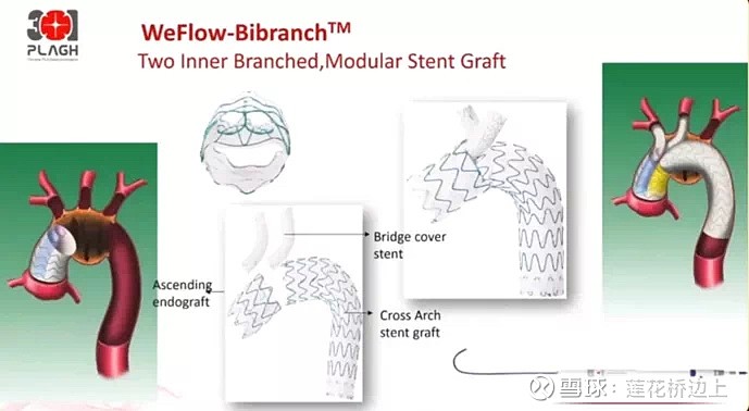 CEC 2022｜郭伟：主动脉系列创新器材多中心临床最新数据解读 2022年12月2号，第14届cec召开，郭伟教授公布了主动脉创新器械的临床进展（转载，学习用） 腔内器材和技术的创新和 ...