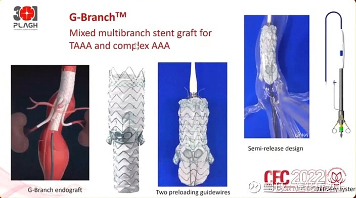 CEC 2022｜郭伟：主动脉系列创新器材多中心临床最新数据解读 2022年12月2号，第14届cec召开，郭伟教授公布了主动脉创新器械的临床 ...