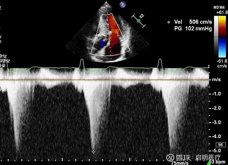 单日三例 | 四川大学华西医院成功应用Liwen RF®射频消融系统完成临床入组 NEWS近日，杭州启明医疗器械股份有限公司（“ 启明医疗 ...