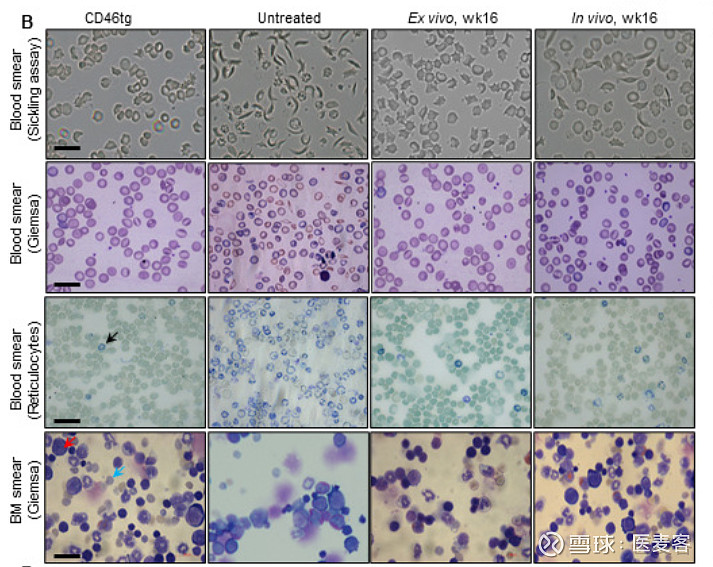 刘如谦最新研究：Prime Editor体内基因编辑修复造血干细胞治疗SCD 2023年2月25日/医麦客新闻 eMedClub News ...