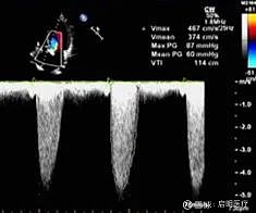 评价完美 | 启明医疗Venus-PowerX®于CRT2023成功完成全球首次手术直播 2月27日，杭州启明医疗器械股份有限公司（“ 启明 ...