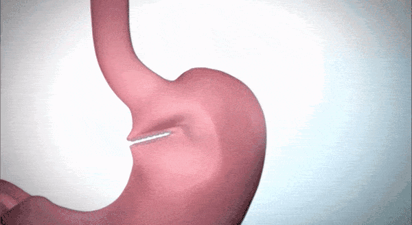 【胃占容】为何能帮你有效减肥？ 转自：赛必健Scibridge 2023-05-19 17:20 发表于上海大多数肥胖的朋友是由于食物摄入过多 ...