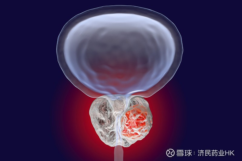 PSMA靶向显像剂Posluma获批用于辅助前列腺癌检测 美国食品和药物管理局(FDA)已批准Posluma(flotufolastat F ...
