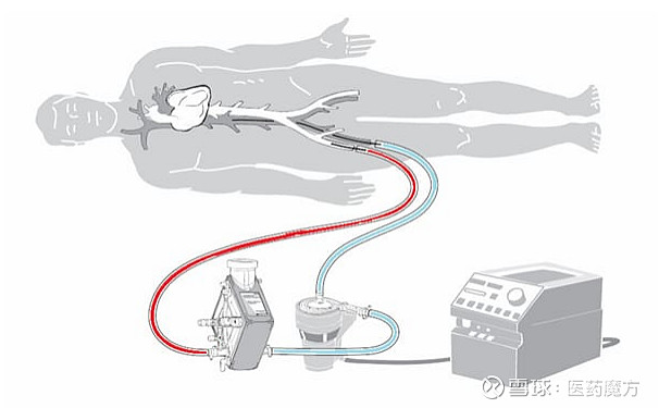 SimECMO-海归科学家打造新一代国产ECMO训练模拟系统 ECMO（Extra-Corporeal Membrane Oxygenation)被称为危重症抢救的终极武器，是一种能... - 雪球