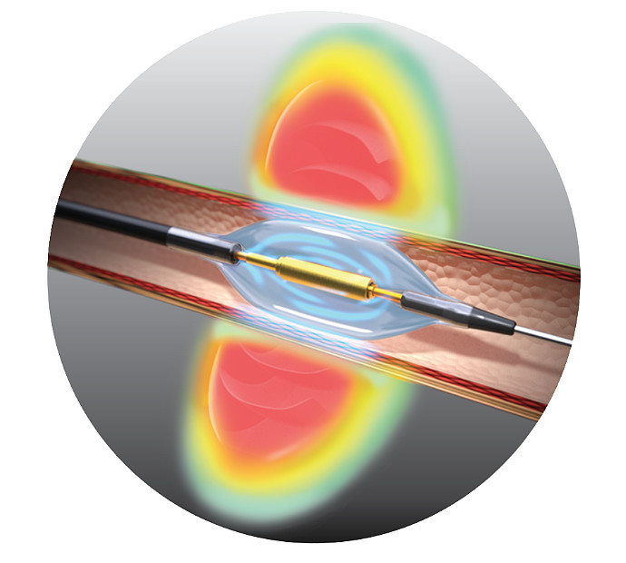 十面埋伏：美敦力的新挑战！ 近期，全球第一、第二款RDN系统获FDA批准一度在行业内引起热烈反响，它们分别是11月7日获批的Recor ...