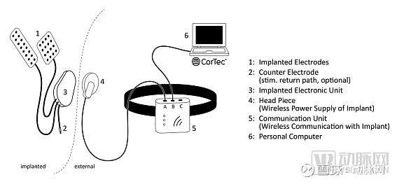 又一植入式脑机接口企业获批人体试验，面向千万中风幸存者 在Neuralink公布其首位植入设备的志愿者遭遇脑内微细线头轻微移位的消息后不久 ...