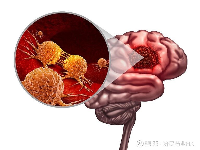 Paxalisib在治疗胶质母细胞瘤的2/3期试验中显示改善患者总生存期 Kazia治疗学公司公布了Paxalisib治疗胶质母细胞瘤的2/3 ...
