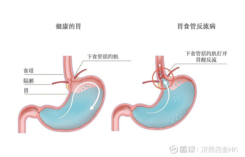 胃食管反流病药物VOQUEZNA扩大批准范围，纳入非糜烂型患者 美国药监局FDA扩大了生物制药公司 Phathom 的药物VOQUEZNA的 ...