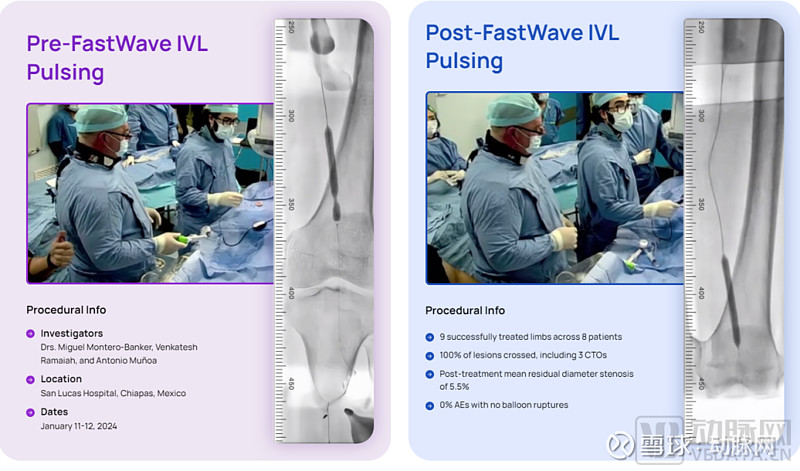 如何用三年成长为冲击波球囊全球明星企业？专访FastWave联合创始人JC Sun 4月5日，强生公司(JNJ)和 Shockwave ...