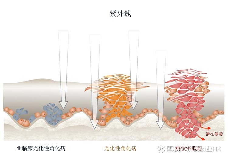 FDA批准增加光化性角化病药物Ameluz凝胶剂量：一次治疗最多三管 近日，美国FDA批准了Biofrontera公司的光化性角化病治疗药物 ...