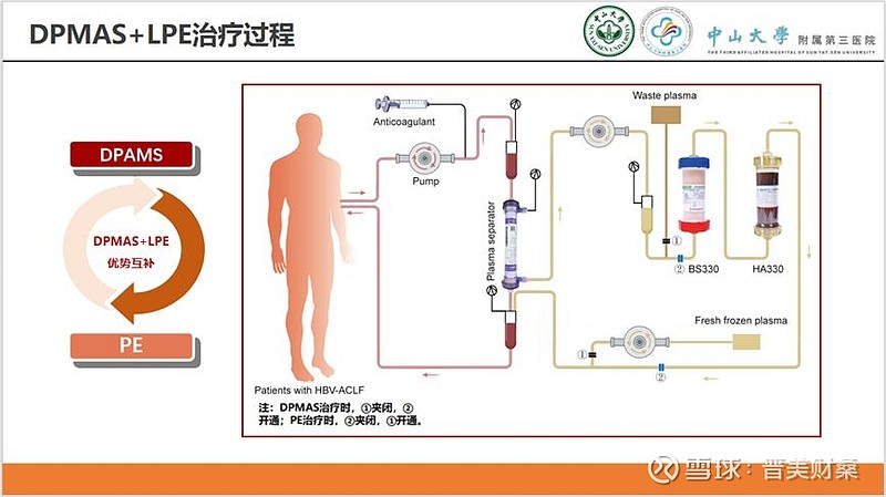 “2024人工肝及血液净化技术示范中心高质量发展学术会议” 彭亮教授：新型人工肝DPMAS组合方案治疗肝衰竭及相关进展人工肝技术发展日新月异 ...