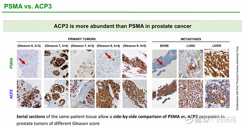 13.5亿美元BD！BMS引进前列腺癌新靶点核药OncoACP3 2025年6月10日，瑞士Philogen集团旗下子公司 Philochem ...