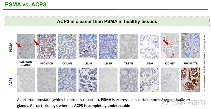 13.5亿美元BD！BMS引进前列腺癌新靶点核药OncoACP3 2025年6月10日，瑞士Philogen集团旗下子公司 Philochem ...